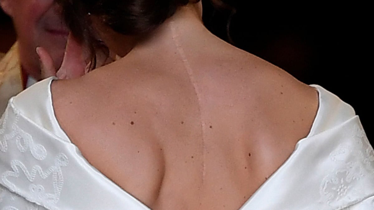 Princess Eugenie wanted her wedding dress to show her scoliosis scar
